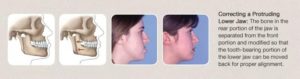 Corrective Jaw Surgery | Orthognathic Surgery | Jaw Misalignment | AAOMS